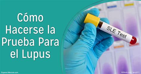 El Análisis Para El Lupus Cómo Analizar En Busca De Lupus
