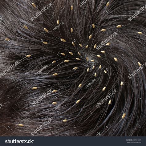 Head Lice Medical Concept As A Close Up Of A Human Head With An Infestation Of Parasitic Nits Or