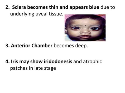 Congenital Glaucoma Optometric Managmentppt Free Download