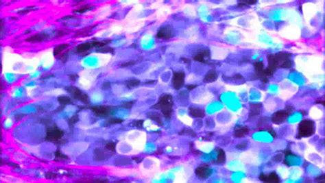 Chemotherapy Response In Neuroblastoma Cells Driven By Random Noise