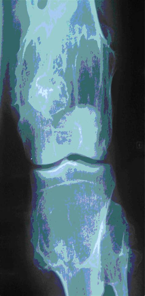 Nicole Delepine Chondrosarcomes Diagnostic