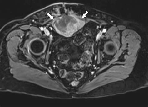 Axial T1 Weighted Post Contrast Magnetic Resonance Imaging Mri