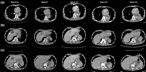 Computed Tomography Scan Of Esophageal A Hepatic B And Lymph Node Download Scientific