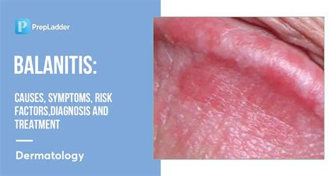 Candidiasis In Men Treatment