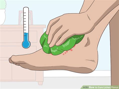 How To Cure Lichen Planus Steps With Pictures WikiHow
