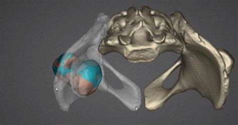 The Use Of 3d Printed Pelvic Models For Complex Acetabular And Femoral