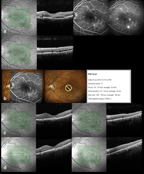 Case Presentation Of Multiple Lesions Male 56 Years Multifocal Cscr Download Scientific