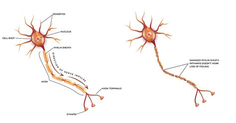 Diabetic Peripheral Neuropathy Lake Charles La Spine And Brain Surgery Dr Matthew Burton Md