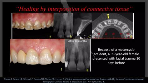 Management Of Tooth Fracture Pptx