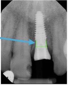 Case Study Abutment Design Fredericksburg VA