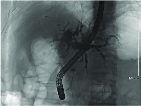 Cholangiogram Showing Distal Stricture And Dilated Bile Duct