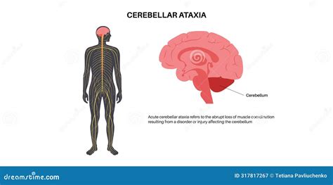 Ataxia Cerebellar Disorder Stock Vector Illustration Of Walking 317817267