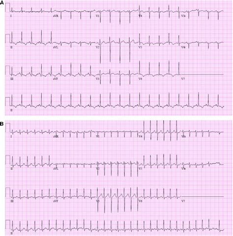 A Focal Automatic Atrial Tachycardia B Focal Re Entrant Atrial