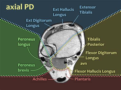 Extensor Hallucis Longus Mri