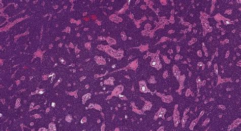 Pleomorphic Adenoma Ottawa Atlas Of Pathology