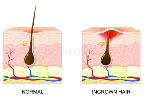 Ingrown Hair Shaving Irritation Stock Vector Illustration Of Hair
