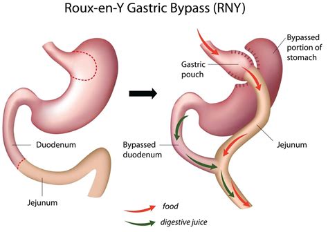 Roux En Y Gastric Bypass Self Pay Surgery