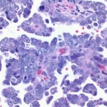 子宮漿液性癌 百度百科