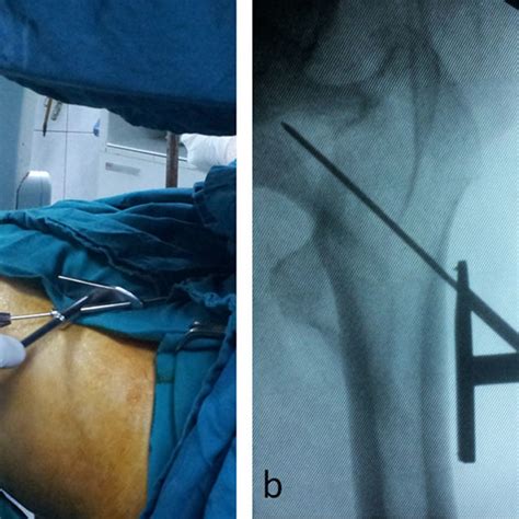 Left Testicular Atrophy After Open Herniotomy Download Scientific Diagram