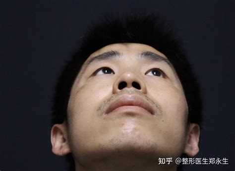 鼻中隔偏曲的危害有哪些？早期有哪些症状？一次给你说明白 知乎