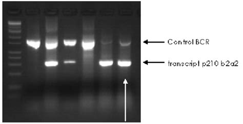 PCR Analysis For Identification Of BCR ABL Transcript Patient SUUB