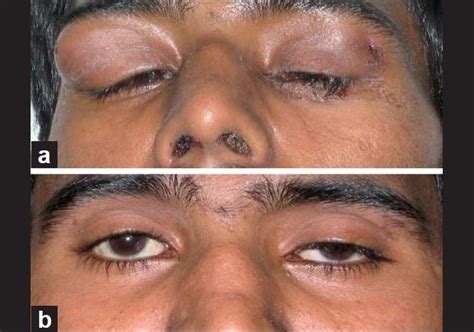 Suppurative Dacroadenitis Causing Ocular Sicca Syndrome In Classic