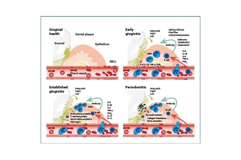 Periodontal Disease And Systemic Health Dentalnursing