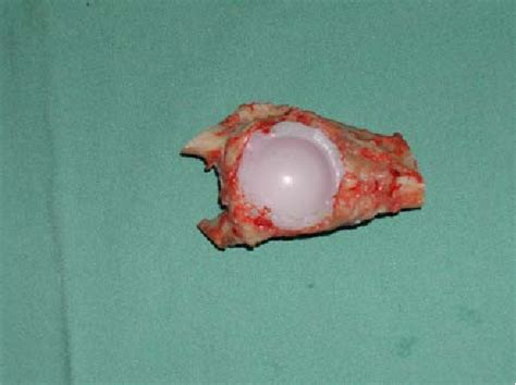 Figure 3 From A Modified Cementing Technique Using Bonesource® To Augment Fixation Of The