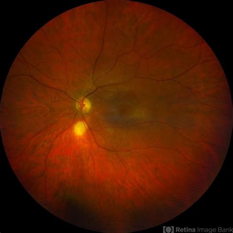Focal Scleral Nodule Retina Image Bank