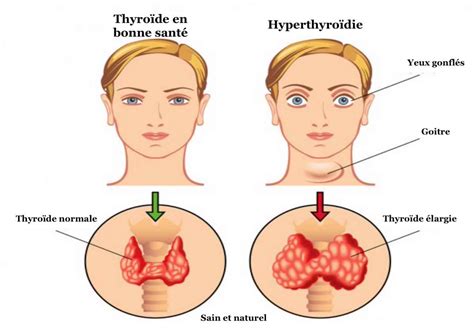 Quest Ce Que La Douleur Dans La Glande Thyroïde Ehjwg
