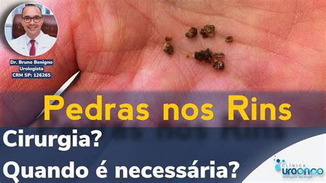 Pedra nos Rins Quando a Cirurgia é Necessária YouTube