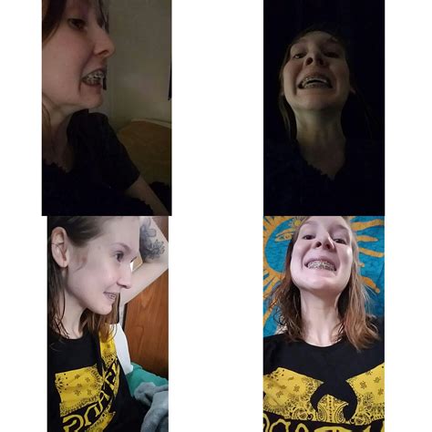 My Jaw Surgery Experience