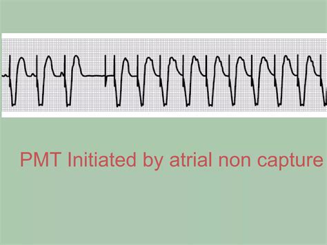 Pacemaker Ecgs Yasmeen Kamal Pptx