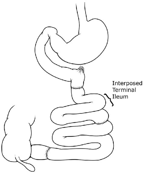 Ileal Interposition A Neurovascular Intact Segment Of Distal Or