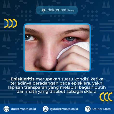 Episkleritis Tanda Penyebab And Pengobatan