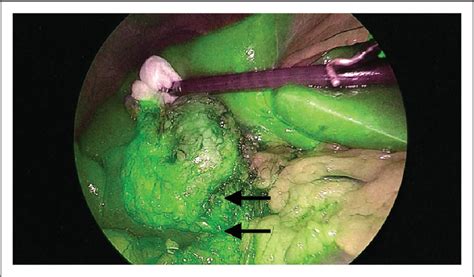 Figure 3 From Robotic Cholecystectomy For Duplicated Gallbladder