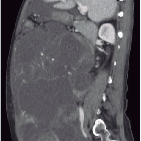 Ct Sagittal Plan Huge Multiloculated Mass With Coarse Septa And Solid