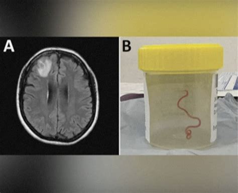 Australian Doctors Find Live Parasitic Worm In Womans Brain Happiest