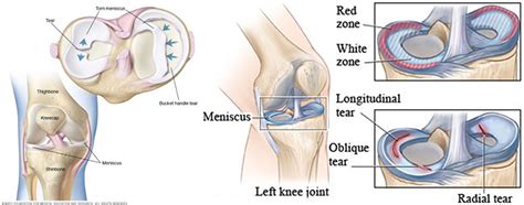 Meniscal Repair Knee Surgery Northern Knee Clinic