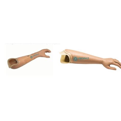 Below Elbow Prosthesis With Passive Hand At Rs 14999piece Artificial Limb Upper Extremity