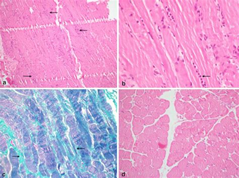 Longitudinal Section Of Muscle Biopsy From Patient 1 Revealing Mild