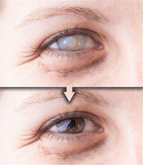 Cataracts Understanding The Age Of Onset
