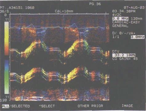五、彩色m型多普勒组织成像 临床心肾彩色多普勒成像 医学
