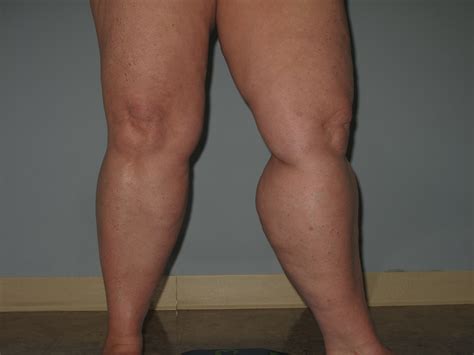 Fat Calves Skinny Body