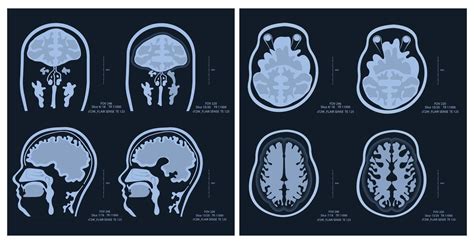 Mri Image Of A Human Brain Showing All The Major Manifestations Of