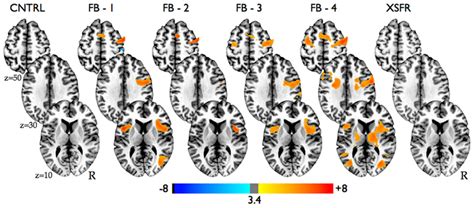 Statistical Parametric Maps Showing Significant Activation Changes From Download Scientific