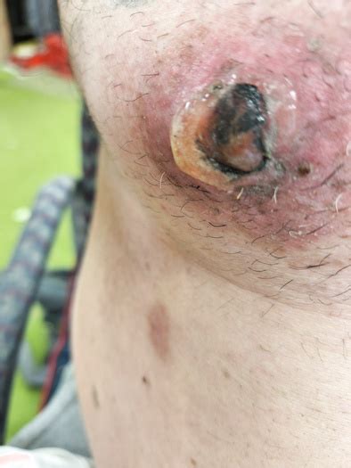 Nipple Burning Album 2 Image 4200907 Thisvid Tube