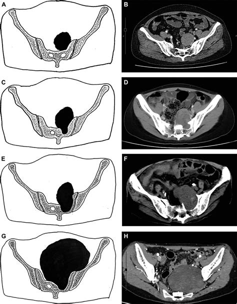 Surgical Strategy And Application Of Robotic Assisted Benign Sacral