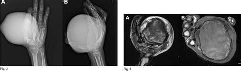 Figure 3 From Surgical Excision Of A Giant Schwannoma Of The Hand