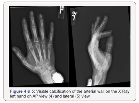 Dialysis Access Steals And Leads To Limb Ischemia Iris Publishers